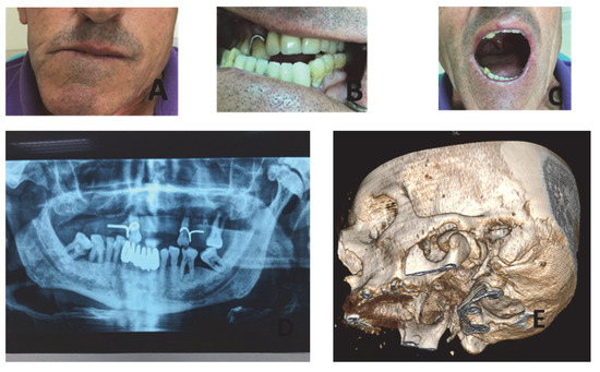 Peripheral Osteoma of the Mandibular Condyle—Case Series