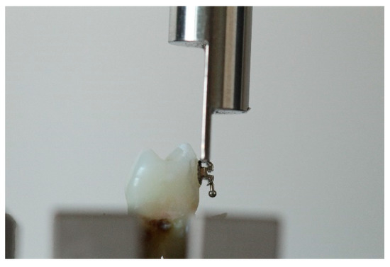 Comparative Evaluation of Two Bracket Systems’ Bond Strength ...