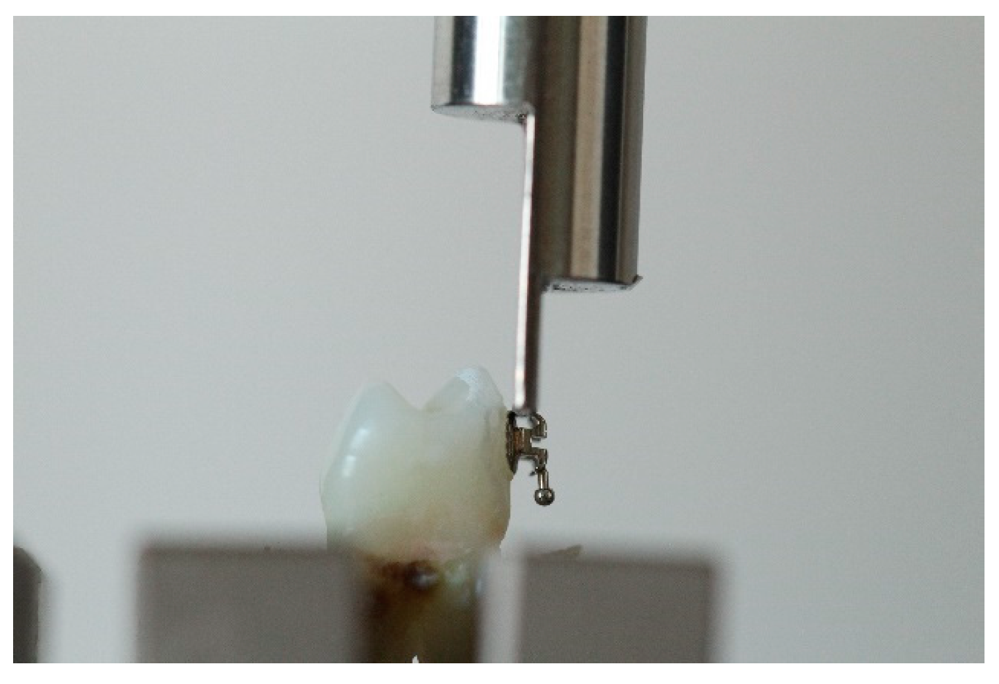 Comparative Evaluation of Two Bracket Systems’ Bond Strength ...