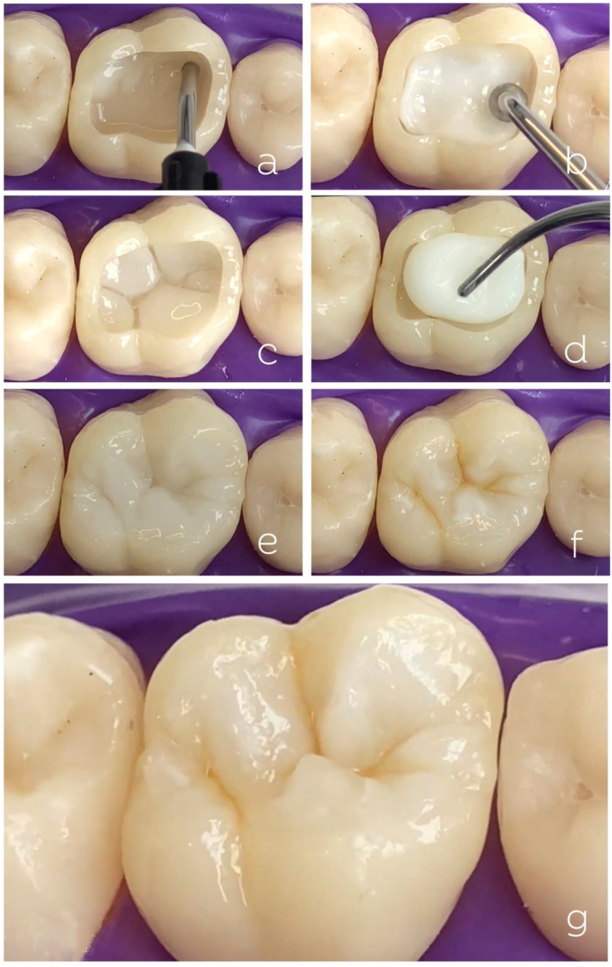 Resin Composites in Posterior Teeth Clinical Performance and Direct Restorative Techniques