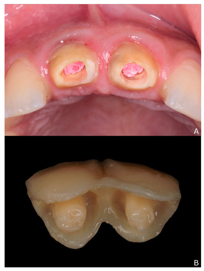 The Use of Polyetheretherketone (PEEK) as an Alternative Post and Core ...