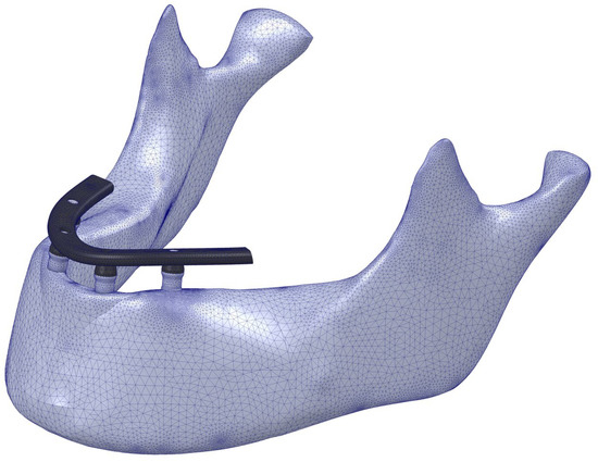 Implant-Supported Prostheses in the Edentulous Mandible: Biomechanical ...