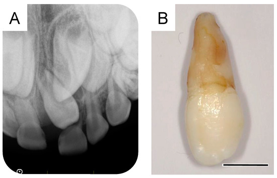 A Third Supernumerary Tooth Occurring in the Same Region: A Case Report