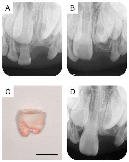 A Third Supernumerary Tooth Occurring in the Same Region: A Case Report
