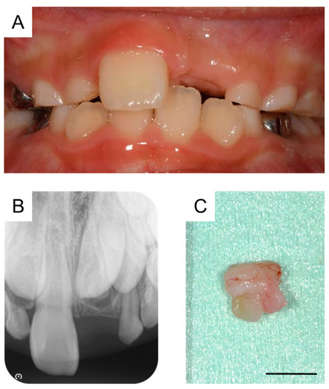 A Third Supernumerary Tooth Occurring in the Same Region: A Case Report