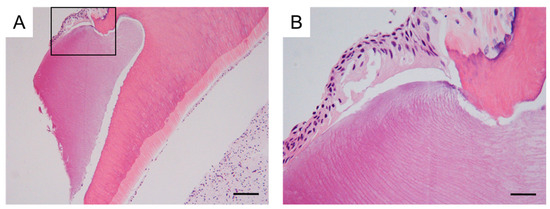 A Third Supernumerary Tooth Occurring in the Same Region: A Case Report