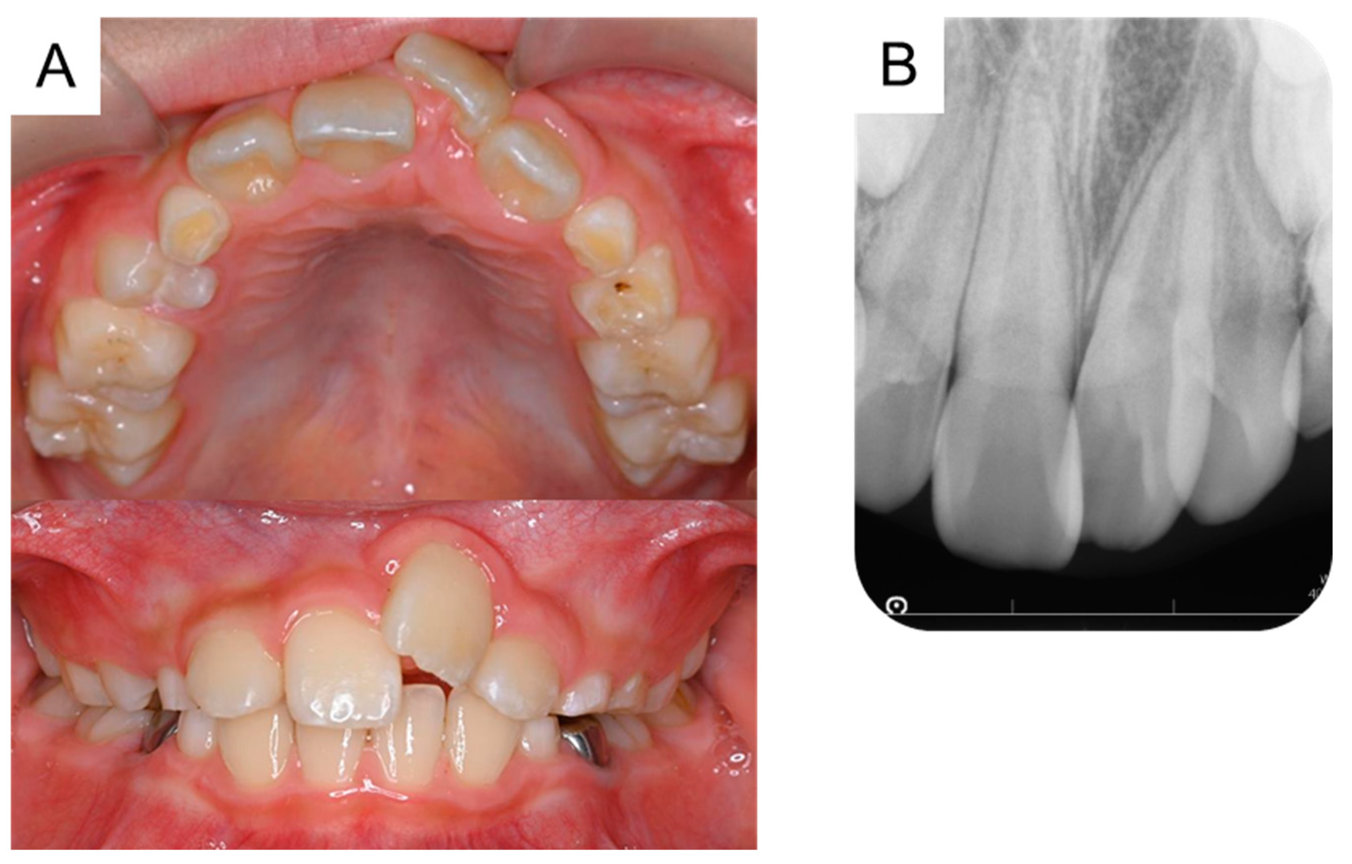 Dentistry Journal | Free Full-Text | A Third Supernumerary Tooth ...