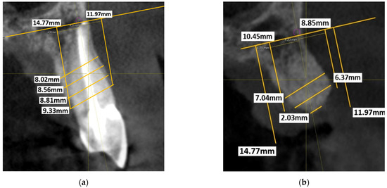 Tomographic Evaluation of Alveolar Ridge Preservation Using Bone ...