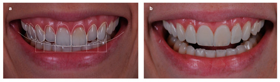 Partial Ceramic Veneer Technique for Challenging Esthetic Frontal ...