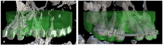 Orthodontic Treatment of Palatally Impacted Maxillary Canines with the ...