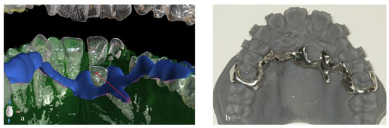 Orthodontic Treatment of Palatally Impacted Maxillary Canines with the ...