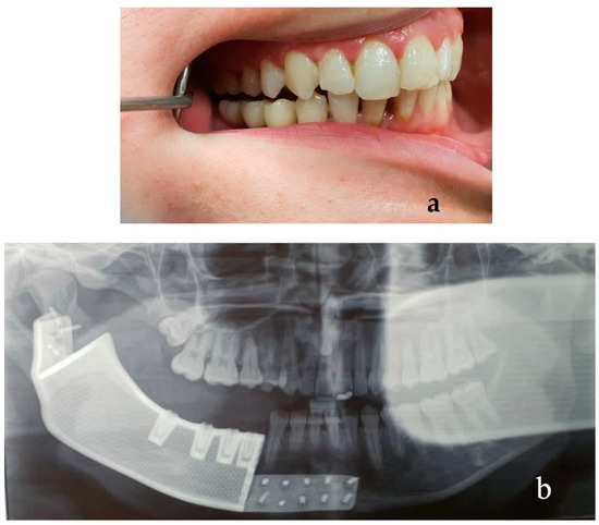 Mandibular Reconstruction after Resection of Ameloblastoma by Custom ...
