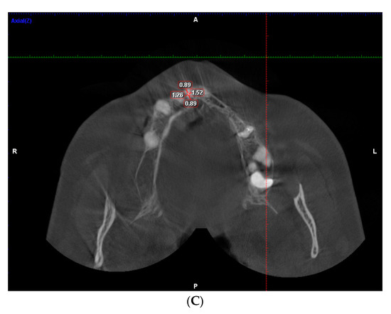Evaluation of Dentinal Thickness and Remaining Dentine Volume around ...