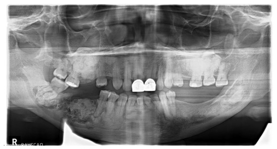 Cemento-Osseous Dysplasia of the Jaw: Demographic and Clinical Analysis ...