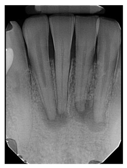 Cemento-Osseous Dysplasia of the Jaw: Demographic and Clinical Analysis ...