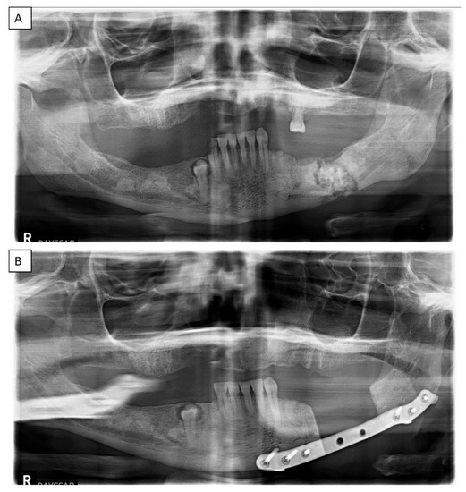 Cemento-Osseous Dysplasia of the Jaw: Demographic and Clinical Analysis ...