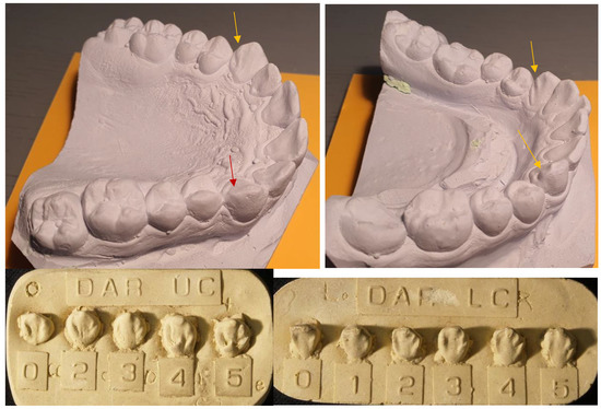 Canine Crown Sexual Dimorphism in a Sample of the Modern Croatian ...