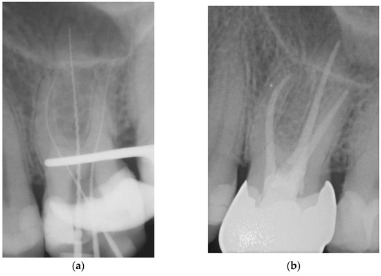 Endodontic Outcome of Root Canal Treatment Using Different Obturation ...
