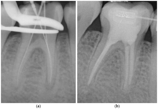Endodontic Outcome of Root Canal Treatment Using Different Obturation Techniques: A Clinical Study