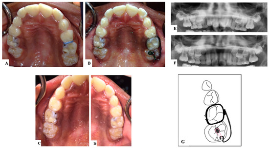 Ectopic Permanent Molars: A Review