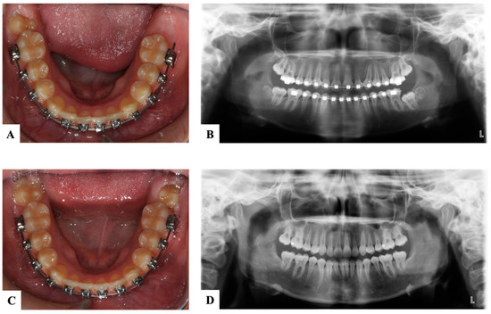 Ectopic Permanent Molars: A Review