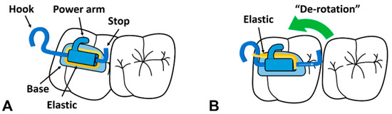 Ectopic Permanent Molars: A Review