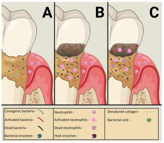 The Role of Bacterial, Dentinal, Salivary, and Neutrophil Degradative ...