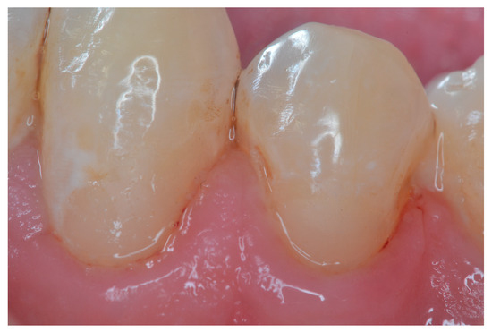 Retrospective Clinical Evaluation of RMGIC/GIC Class V Restorations