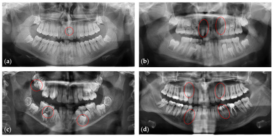 Supernumerary Tooth Patterns in Non-Syndromic White European Subjects