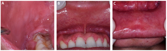 Oral Secondary Syphilis in an HIV-Positive Transgender Patient: A Case ...