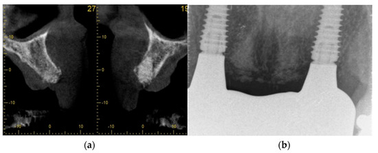 Alveolar Ridge Preservation with Autologous Platelet-Rich Fibrin (PRF ...