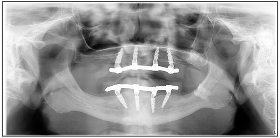 Dentistry Journal | Free Full-Text | Biomechanical Effects of Different ...