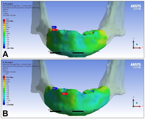 Dentistry Journal | Free Full-Text | Biomechanical Effects of Different ...