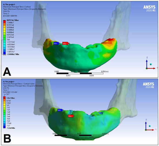 Dentistry Journal | Free Full-Text | Biomechanical Effects of Different ...