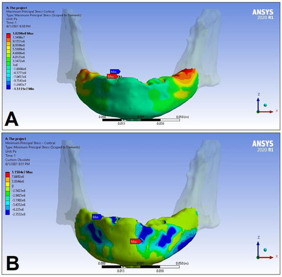 Dentistry Journal | Free Full-Text | Biomechanical Effects of Different ...