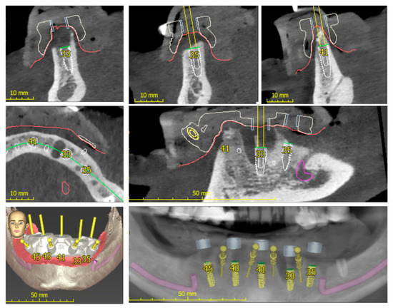 Automation in Dentistry with Mechanical Drills and Lasers for Implant ...