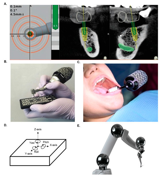 Automation in Dentistry with Mechanical Drills and Lasers for Implant ...