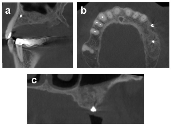 Clinical and Biological Validation of an Allogeneous Cancellous Bone ...