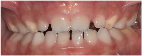 Dental Developmental Defects: A Pilot Study to Examine the Prevalence ...