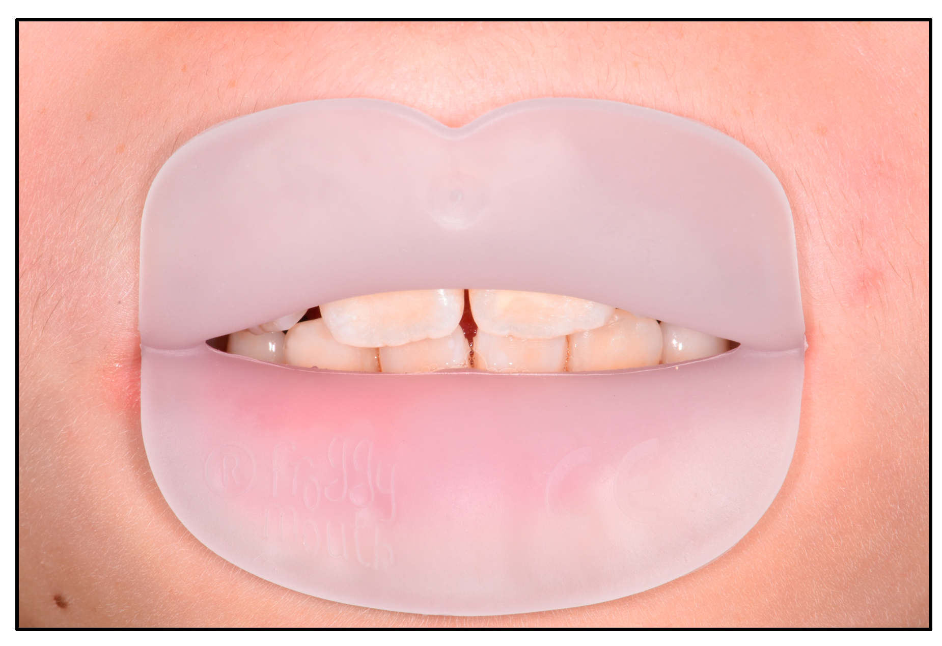 Effects of Froggy Mouth Appliance in Pediatric Patients with Atypical ...