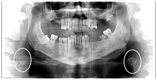 Carotid Artery Calcification Detected on Panoramic Radiography Is ...