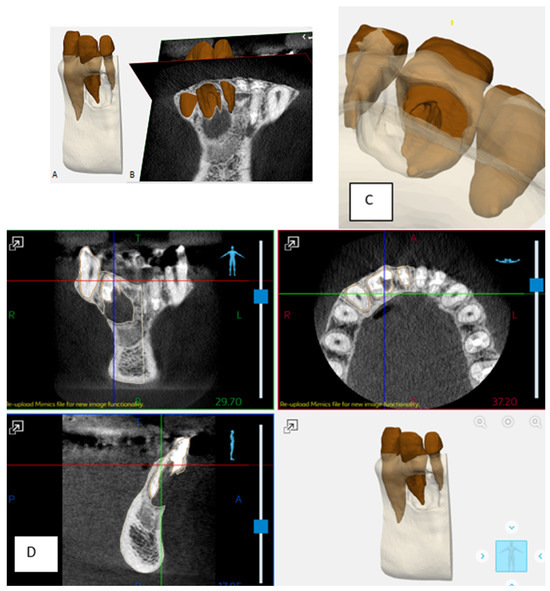 A Novel Diagnostic and Treatment Approach to an Unusual Case of Dens ...
