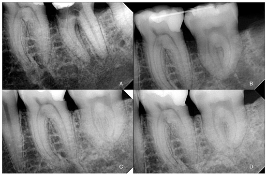 Computer-Guided Surgery Can Avoid Prophylactic Endodontic Treatment in ...
