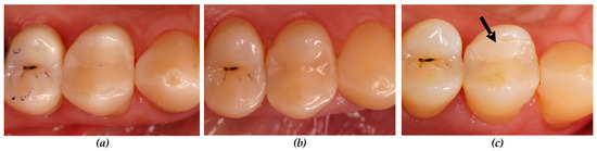 Influence of Cavity Lining on the 3-Year Clinical Outcome of Posterior ...