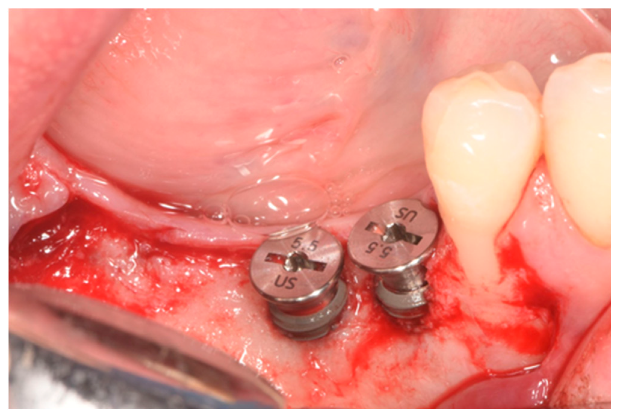 A Comparison of Guided Bone Regeneration vs. the Shell Technique Using ...