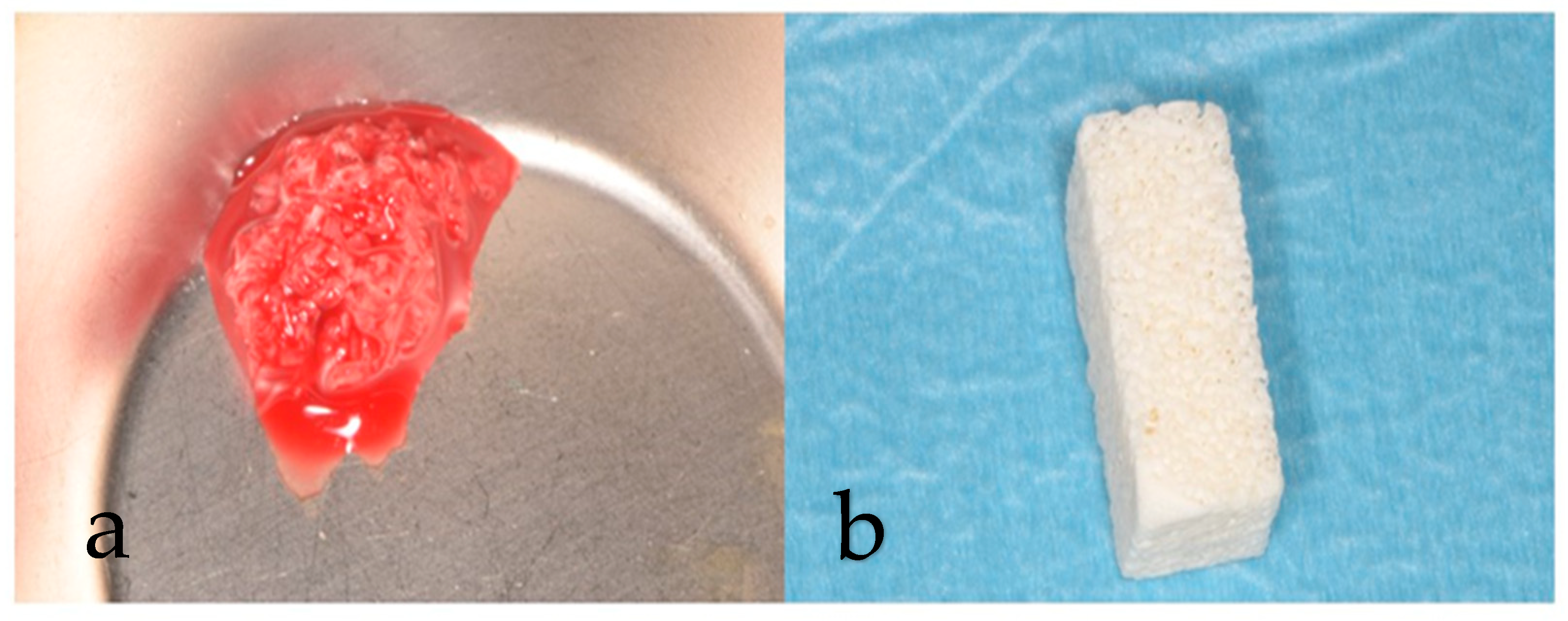 A Comparison of Guided Bone Regeneration vs. the Shell Technique Using ...