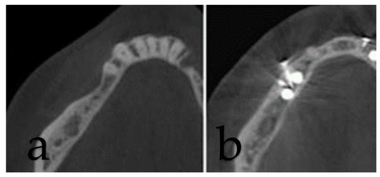 A Comparison of Guided Bone Regeneration vs. the Shell Technique Using ...