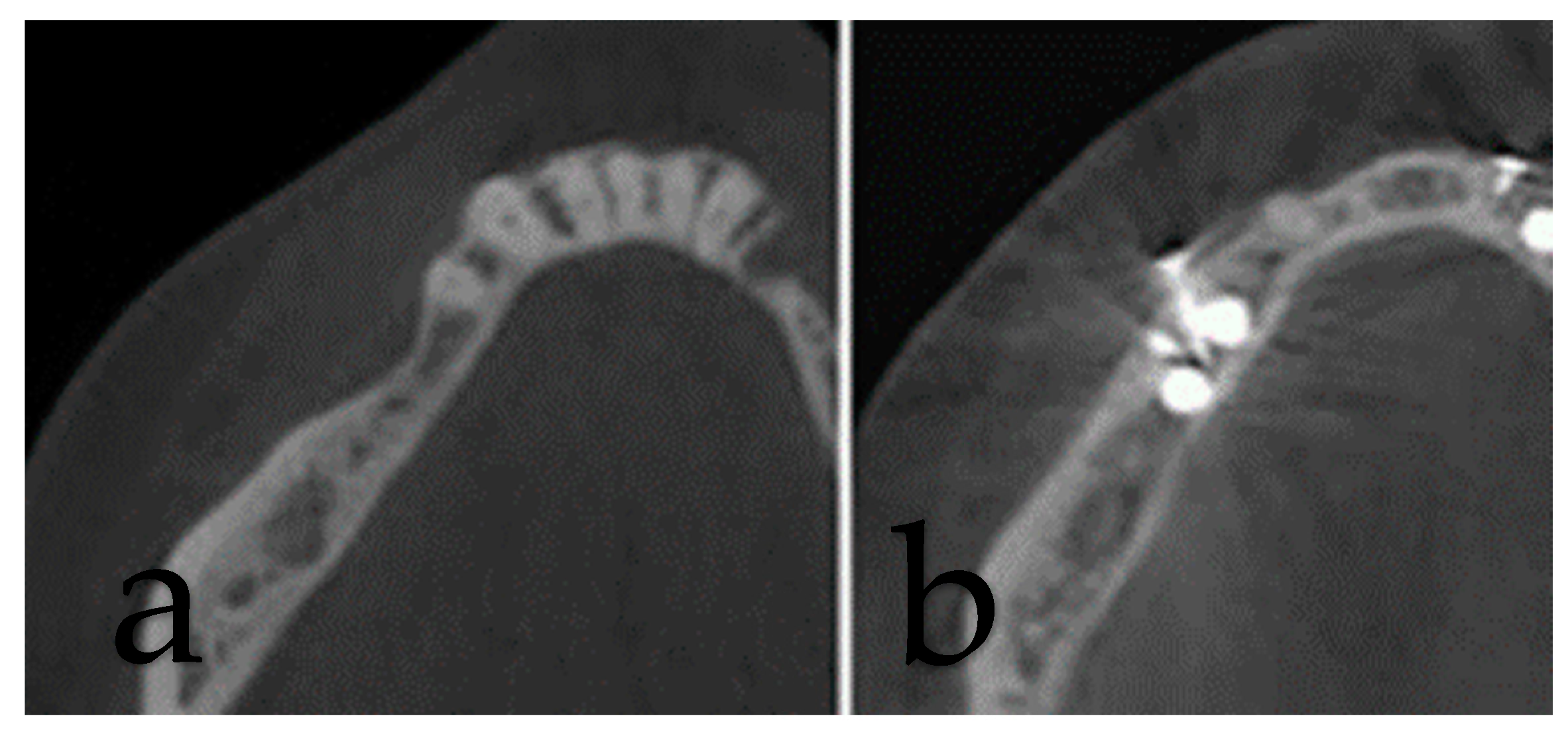 A Comparison of Guided Bone Regeneration vs. the Shell Technique Using ...