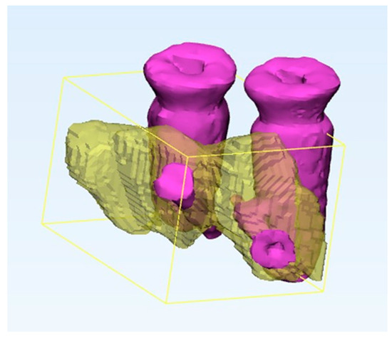 A Comparison of Guided Bone Regeneration vs. the Shell Technique Using ...