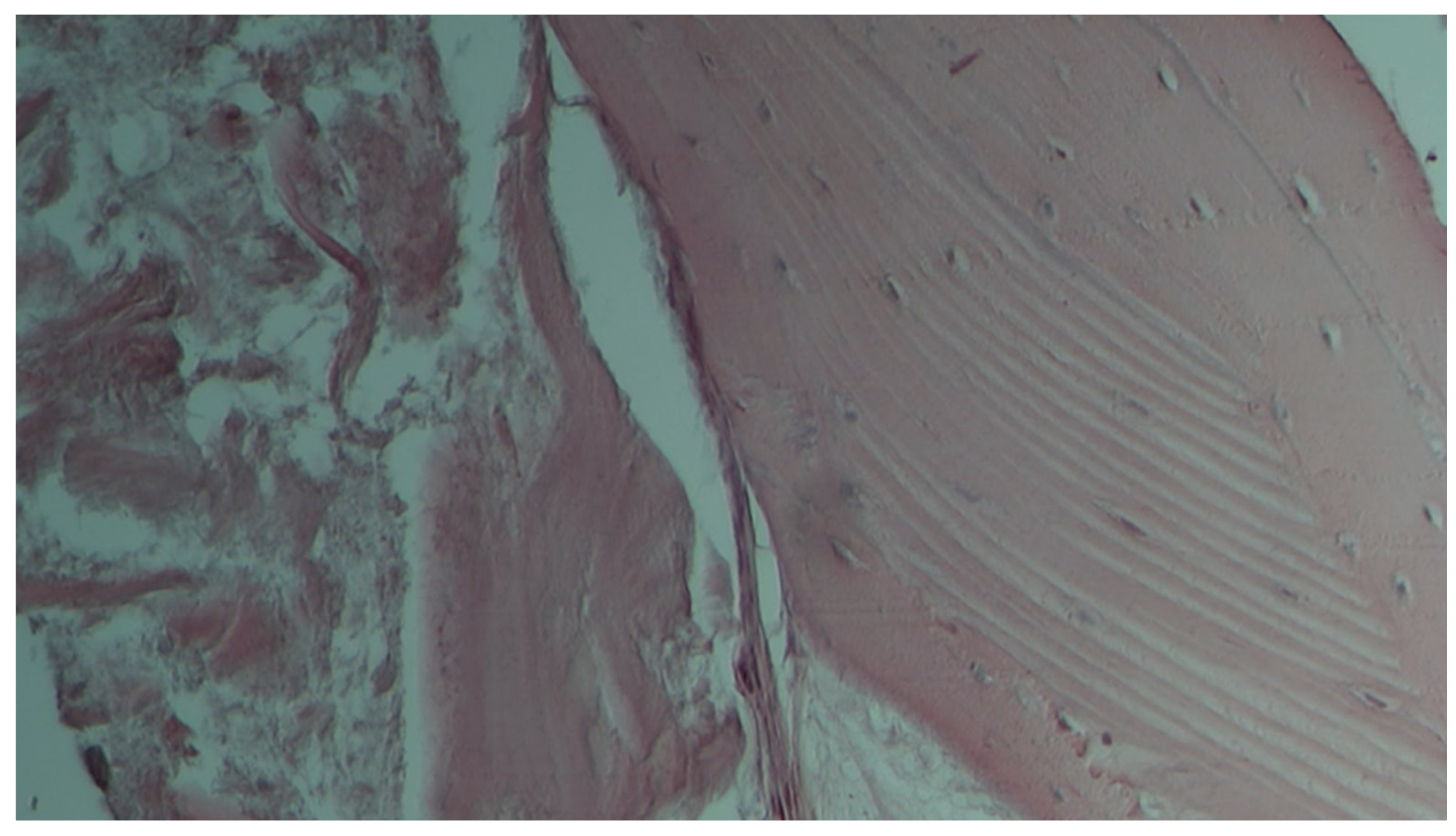 A Comparison of Guided Bone Regeneration vs. the Shell Technique Using ...